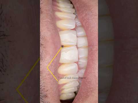 Yellow Teeth Fast Solution.