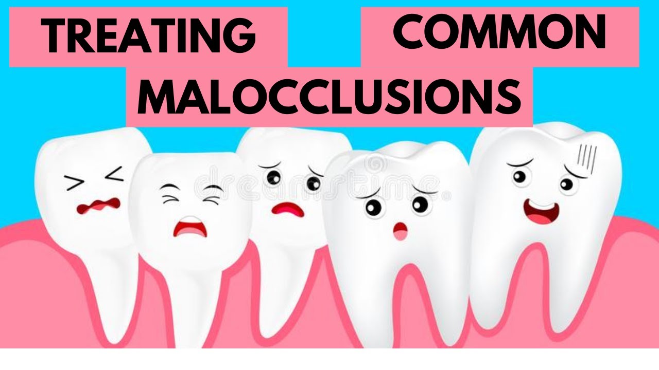 Management of Common Malocclusions -Orthodontics
