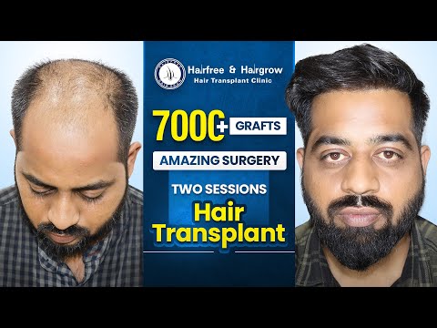 Vishal Sonavne's Hair Transplant in Mumbai | Amazing Hair Transplant Results & Cost in Mumbai