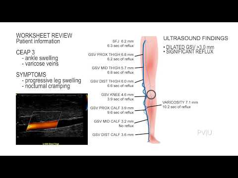 Case study - Reflux in GSV with varicosity