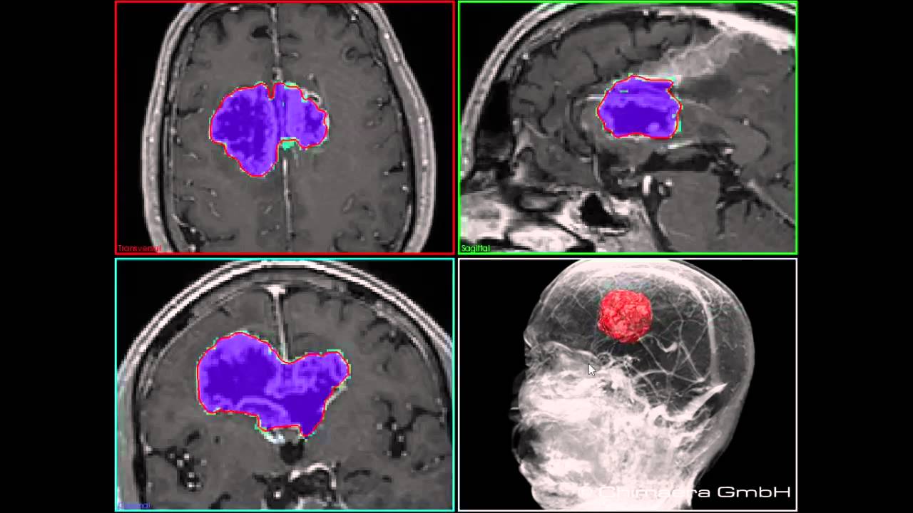 Semi-Automatic Medical Image Segmentation