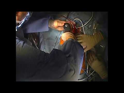 Asvide: An HCS approach was started with a 4th intercostal thoracotomy, followed by a median...