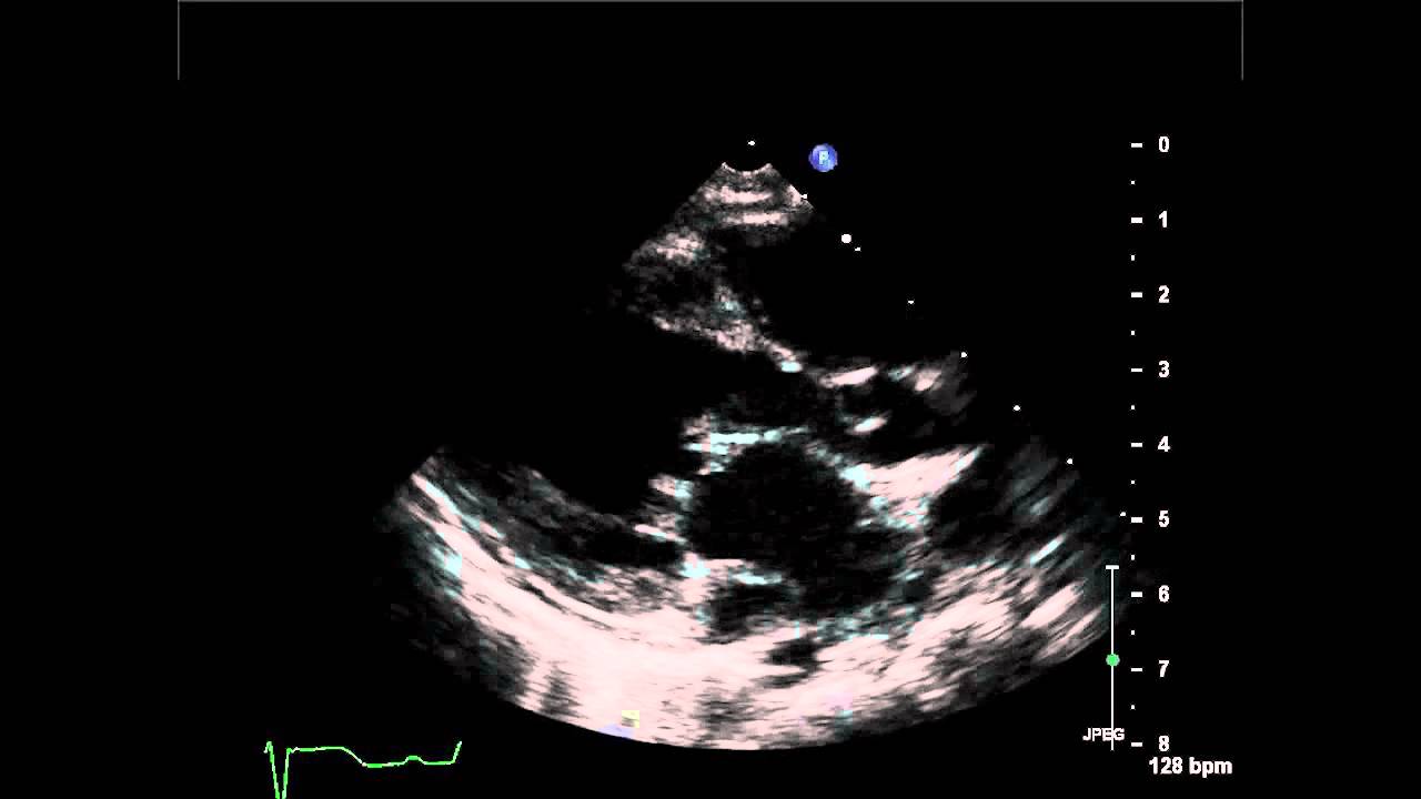Coronary Sinus Atrial Septal Defect Parastermal Long Axis View with Dilated Coronary Sinus
