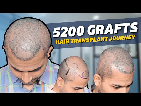 Hair Transplant in Bhubaneswar | Best Results & Cost of Hair Transplant in Bhubaneswar