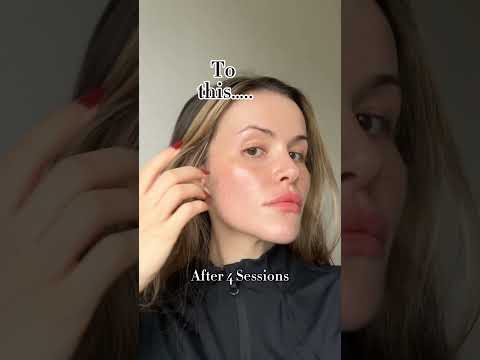 'How This Treatment Transformed My Skin'