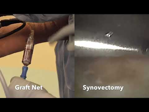 Incisionless Knee Synovectomy and Biopsy With Needle Arthroscope and Autologous Tissue Collector