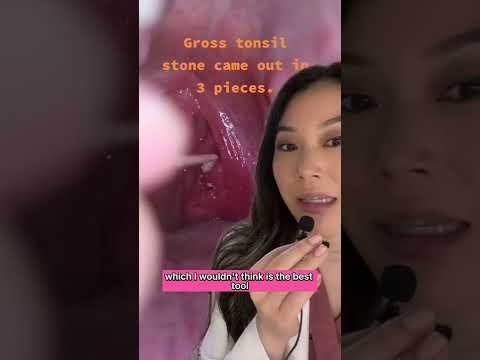 SKILLFULLY removing huge juicy Tonsil Stones with a Sharp wooden pick! #tonsilstones