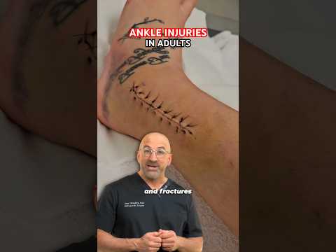 Ankle Fracture 🚫 Not Just the Young #shorts