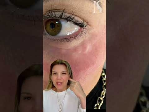 Essas rugas surgem em geral entre 35 e 40 anos!😧 Atualmente podemos tratá-las com o EVO PDRN .