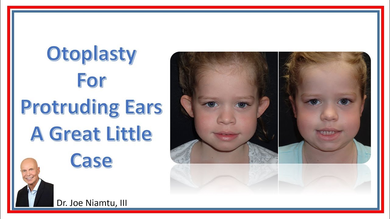 Otoplasty for Protruding Ears: Great Little Cases