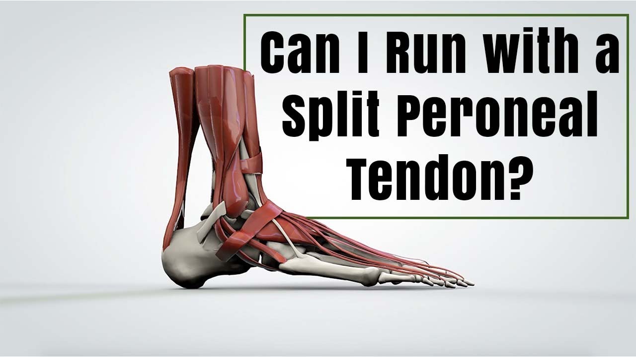 Can I Run with a Split Peroneal Tendon