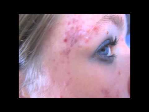 Comment traiter microkystes visage ? La réponse est sur Admicile.fr