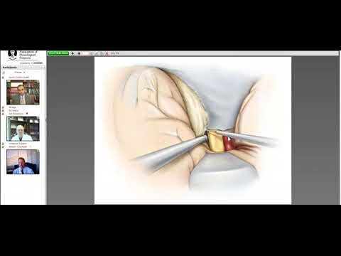 Grand Rounds Resection of Olfactory Groove and Tuberculum Sella Meningiomas