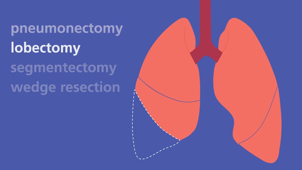 What is a Lobectomy