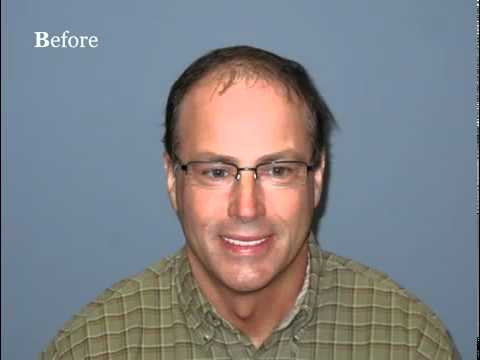 HAIR TRANSPLANT RESULT BEFORE AND AFTER 6MONTHS