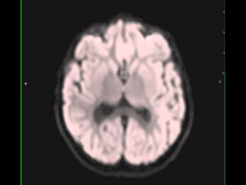 Periventricular White Matter Injury of Prematurity