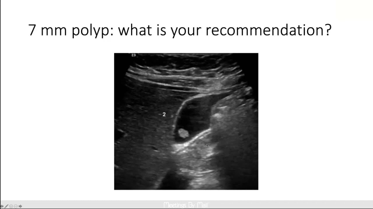 SRU Gallbladder Polyp Consensus Committee Guidelines-- Aya Kamaya, MD (SRU 2021)
