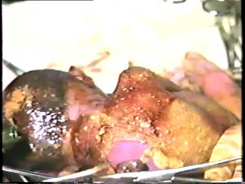 Secondary abdominal pregnaccy---full term- oprative technique