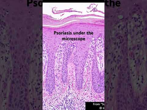 Psoriasis skin biopsy under the microscope - What the pathologist sees! #pathology #dermpath