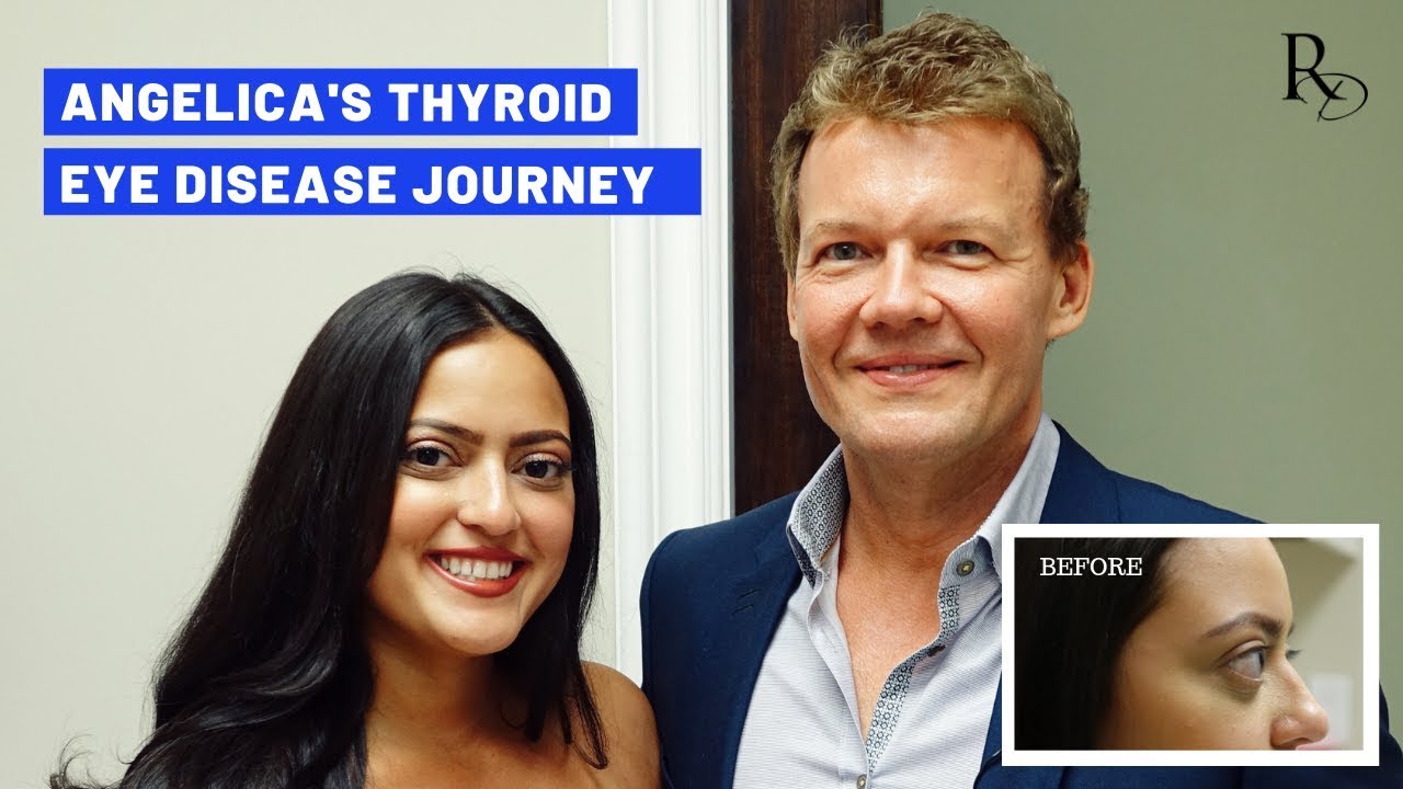 Angelica's Thyroid Eye Disease Journey - Dr Raymond Douglas