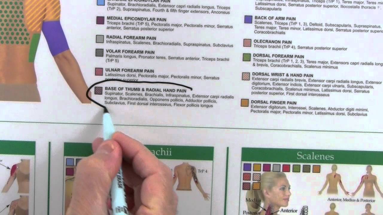 Upper Extremity Trigger Point Wall Chart
