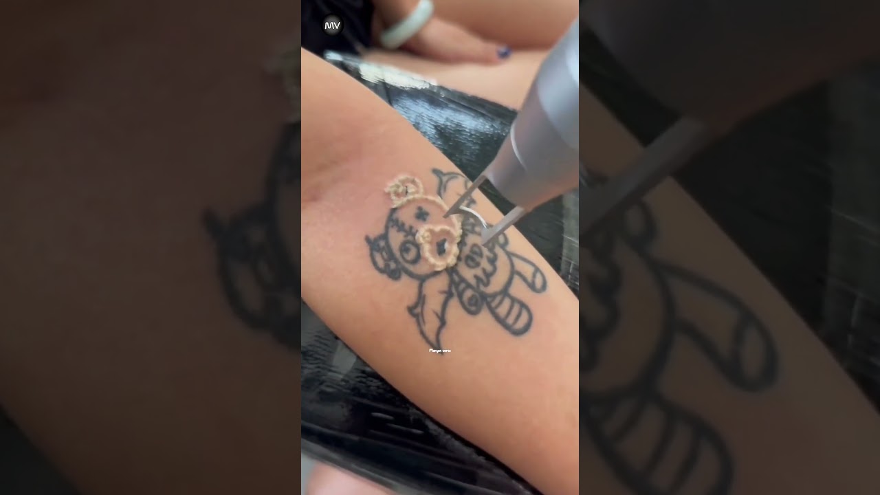 PFD Laser tattoo removal