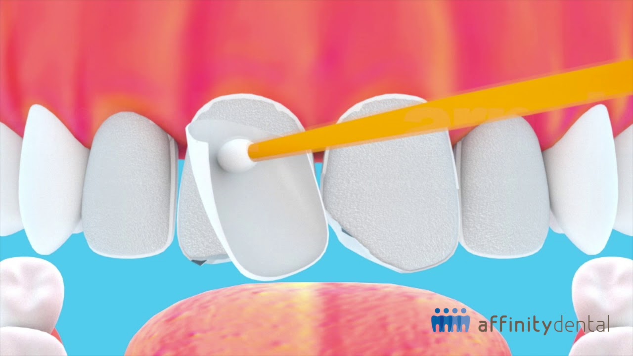 Affinity Dental Porcelain Veneers. The Magic of Cosmetic Dentistry.
