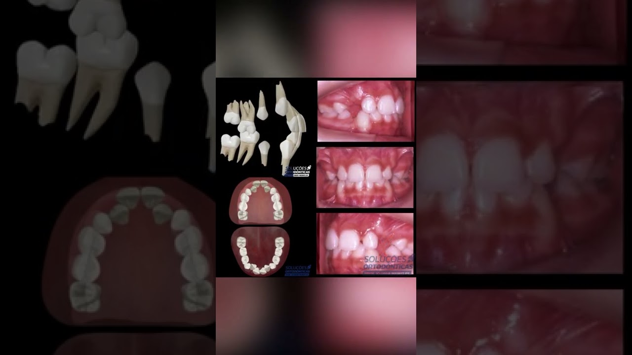 Serial Extractions - ORTHODONTIC TIPS #Shorts