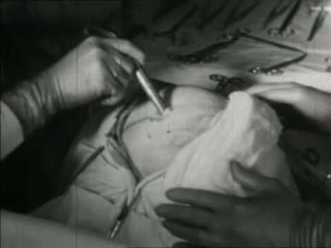 Ovariotomy for Large Cystoadenoma Ovarii (1933), pt. 1 of 4