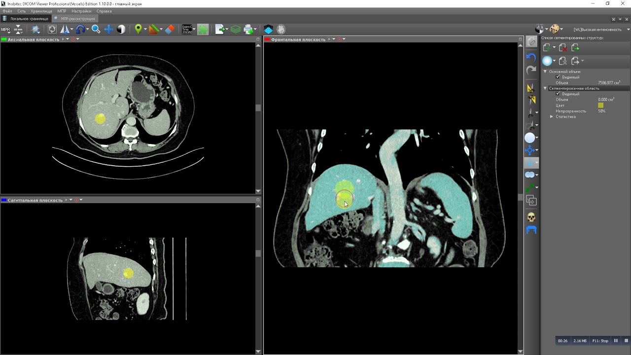 Segmentation using level set region growing