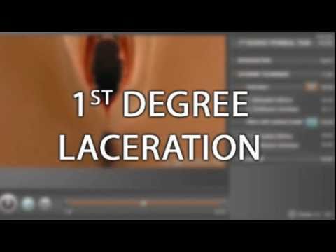 Trailer - Chapter on First Degree Perineal Tear