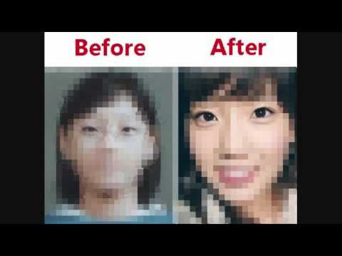 SNSD Plastic Surgery 少女時代 整形.mp4