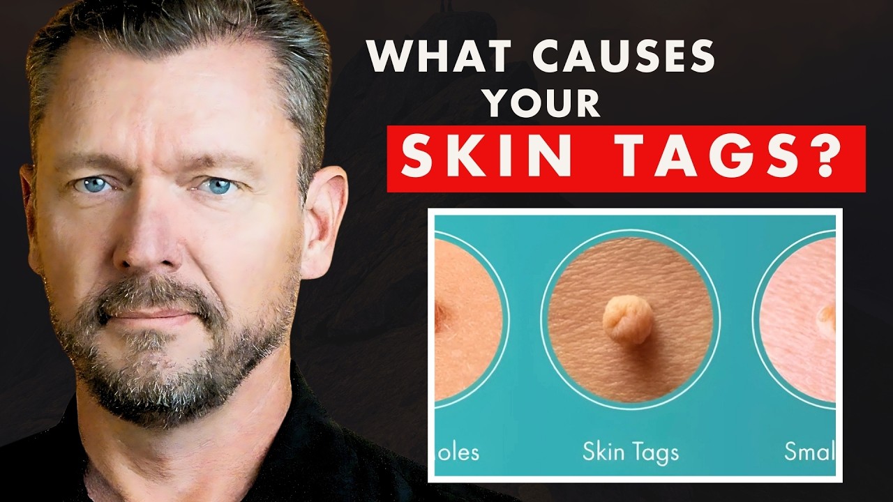 Understanding Skin Tags: What They Really Mean and Their Connection to ...