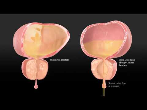 GreenLight Laser Therapy for BPH at Associated Urological Specialists