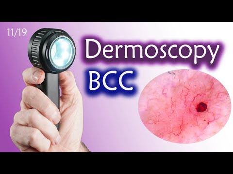 The Dermoscopy of Basal Cell Cancers [BCC's]
