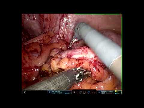 Robotic interval appendectomy