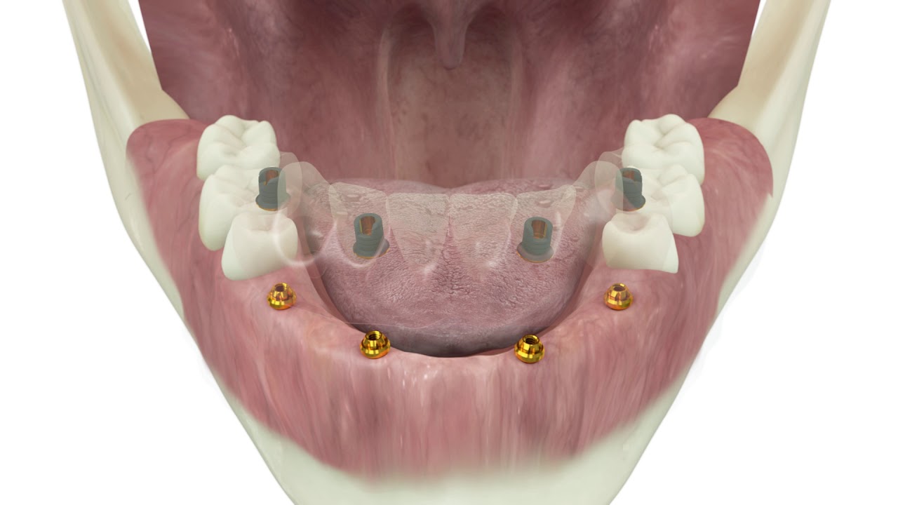 Compressive MS   Overview   Fully screw retained prosthetic options   V1