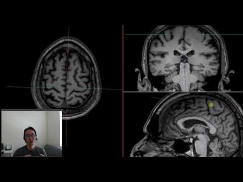 3 tips to find the central sulcus
