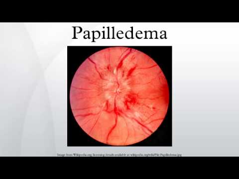 Papilledema