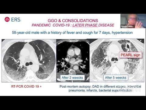 COVID-19 and the management of Interstitial Lung Diseases patients: challenges and recommendations