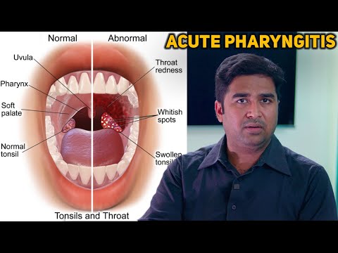 Is Acute Pharyngitis Serious?|அக்யூட் ஃபரிங்கிடிஸ்' ஆபத்தானதா?| Dr. Vignesh Gokul ENT Doctor