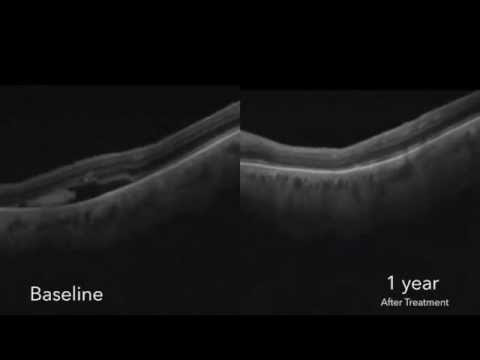 90 year old male patient - 1 year results