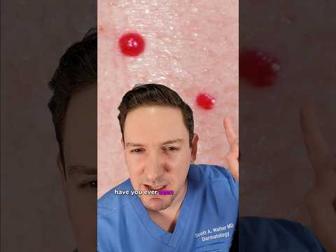 What are Cherry Angiomas? #redbumps #cherryangioma #dermatologist