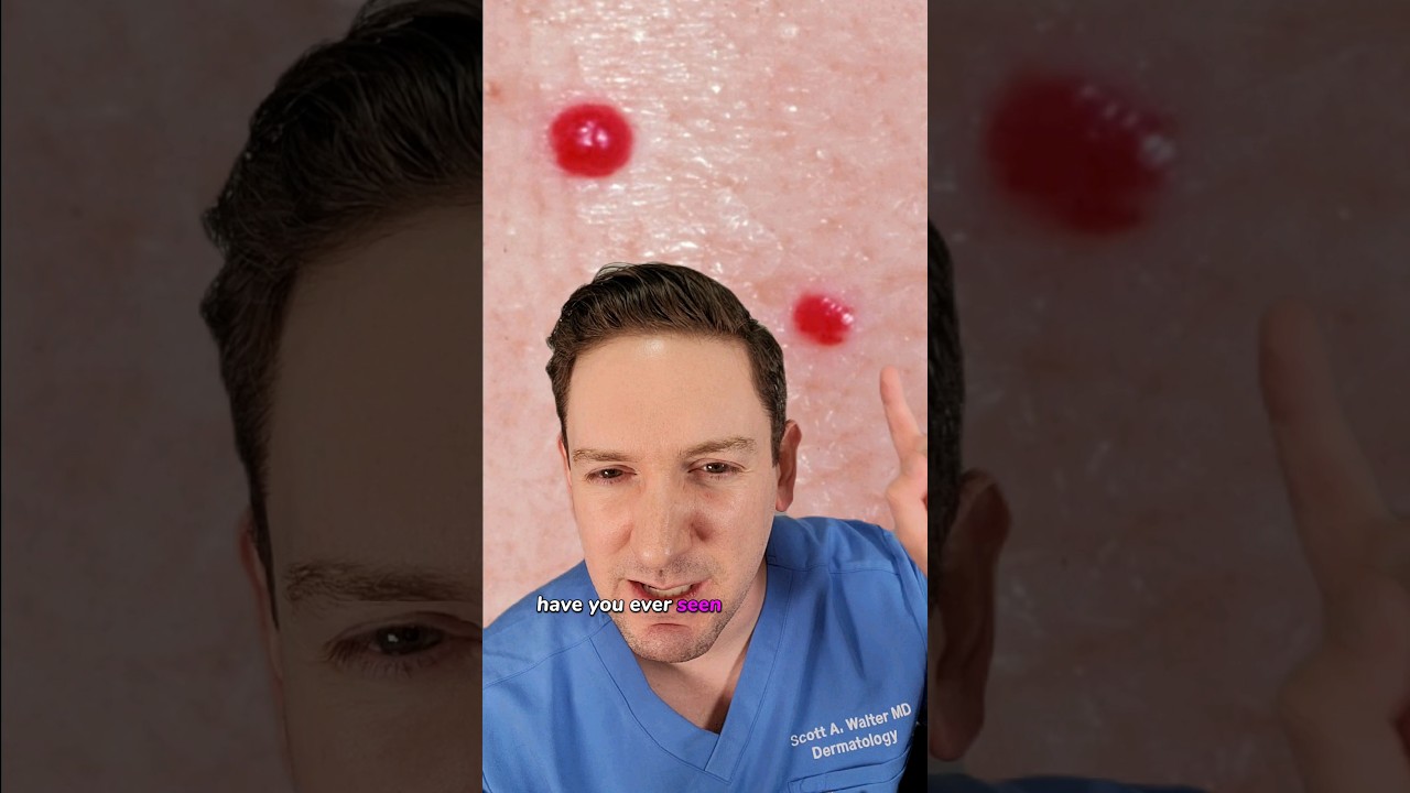 What are Cherry Angiomas? #redbumps #cherryangioma #dermatologist
