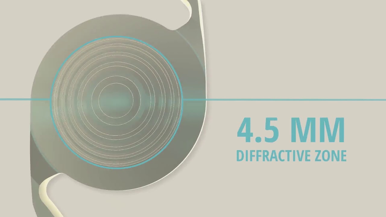 Toric Multifocal Lens IOL For Cataract/ Motiyabind Surgery, 58% OFF