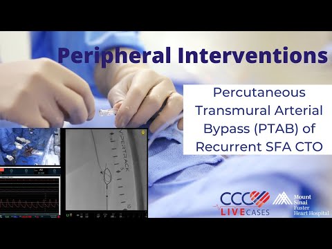 Percutaneous Transmural Arterial Bypass (PTAB) of Recurrent SFA CTO