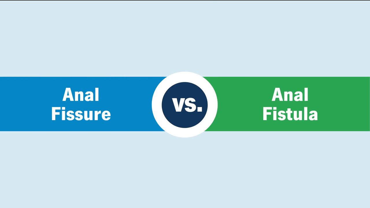 Anal Fissure vs. Fistula