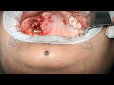 part 1 - unblind pterygoid approach-Dr. c. murugavel for precise pterygoid implant surgery