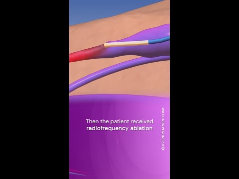Amazing vein treatment results!