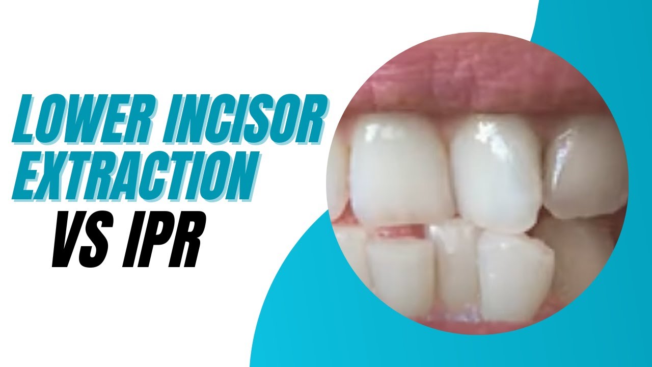 Lower incisor extraction vs IPR